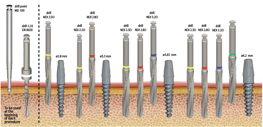 Nova Implants - SURGICAL PROCEDURES